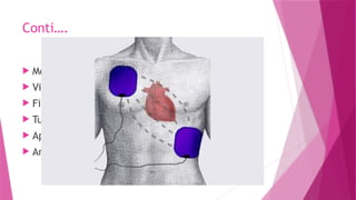 CARDIOVERSION.pptx medical surgical nursing. | PPTX