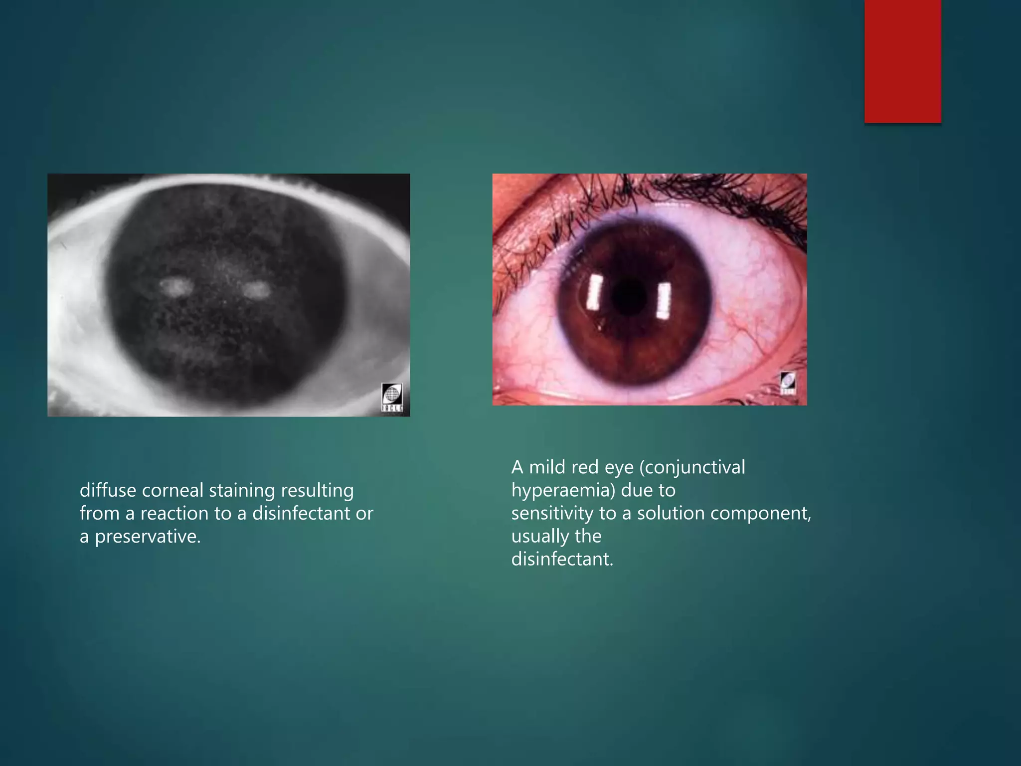 Care and maintenance of contact lenses | PPTX