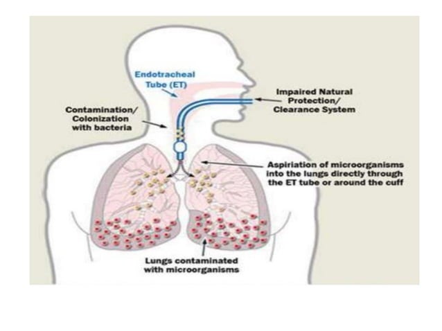PREVENTION OF HAI : CARE BUNDLE APPROACH | PDF | Lung and Respiratory ...