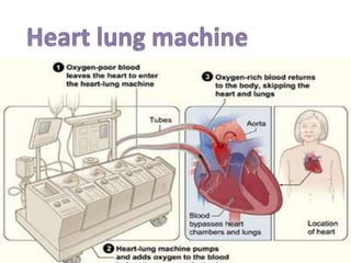 Care cardiac surgery | PPTX