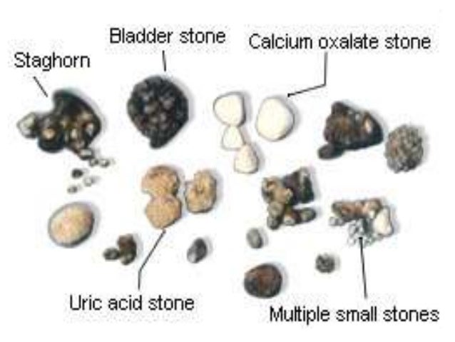 Care Conference Urinary Tract Stone