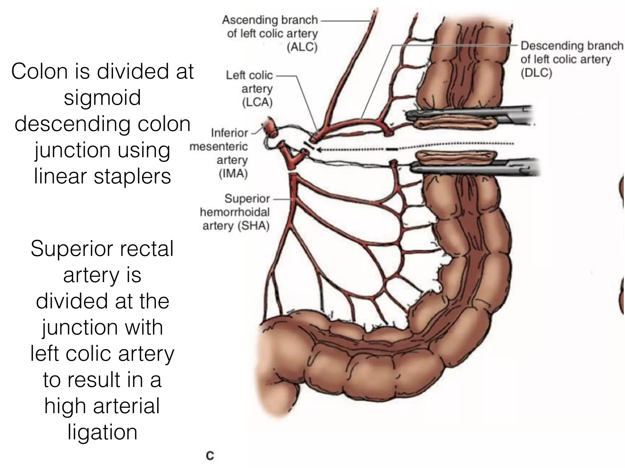 carcinoma rectum | PDF