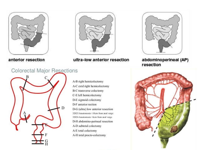 Ca rectum Management seminar 2019 | PPTX | Digestive Disorders | Diseases and Conditions