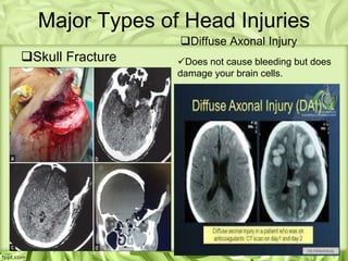 Care of patient with head injury | PPTX