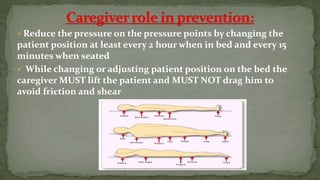 Caregiver role in prevention and management of pressure ulcer | PPTX