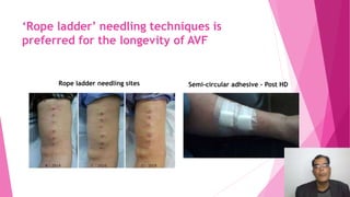 Care of AV Fistula (with explanation on download).pptx