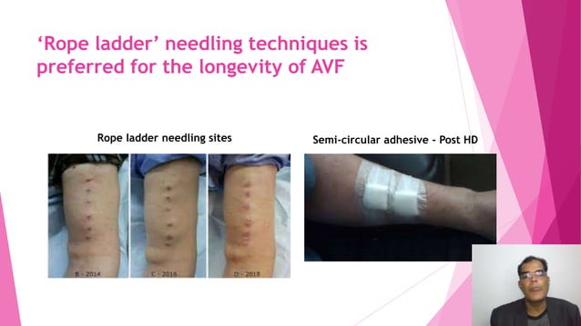 Care of AV Fistula (with explanation on download).pptx | First Aid ...