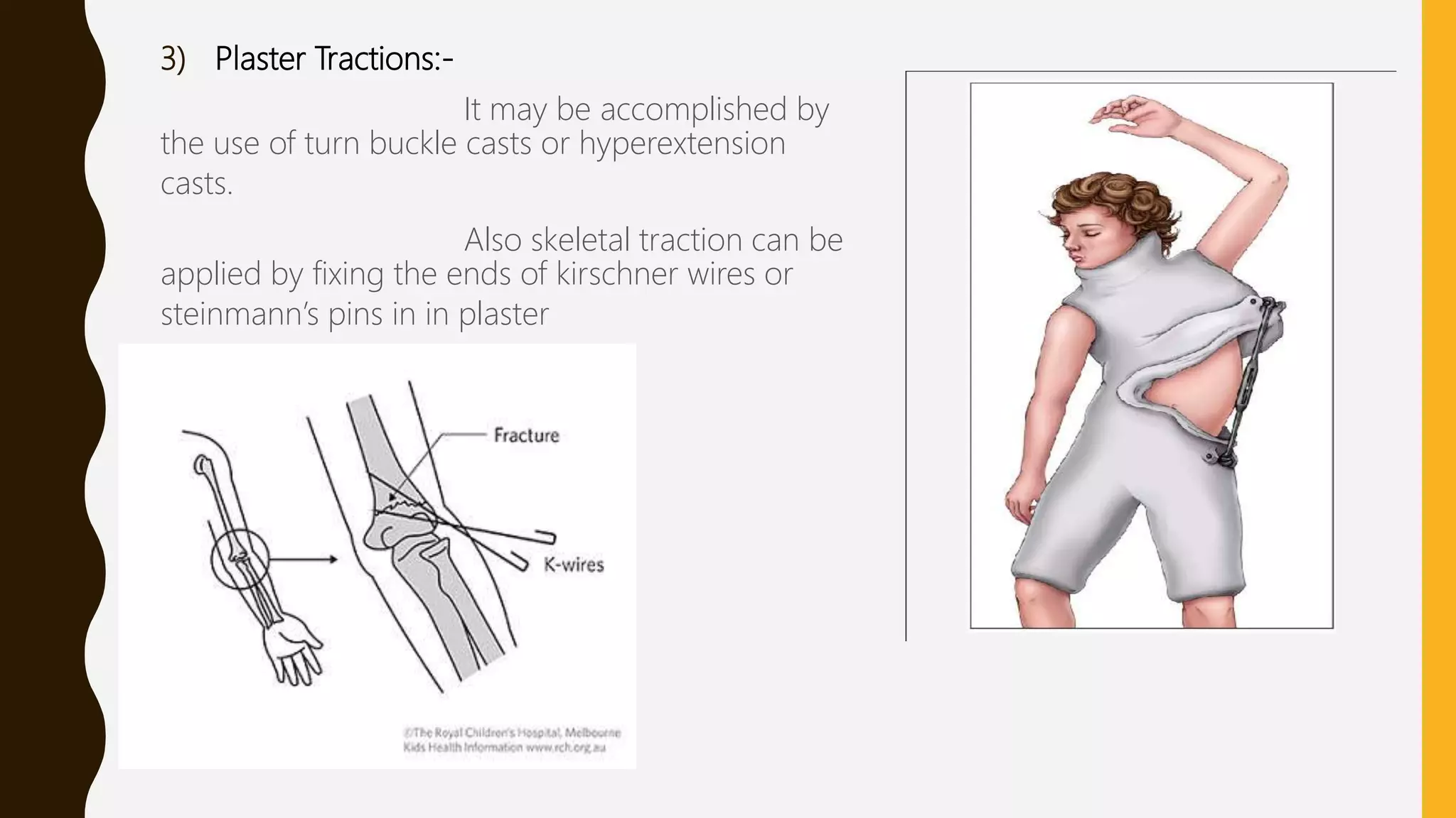 Care of bedridden patient [traction] | PPTX