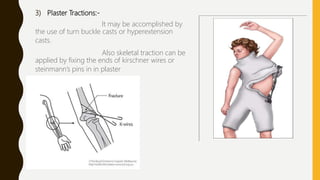 Care of bedridden patient [traction] | PPTX