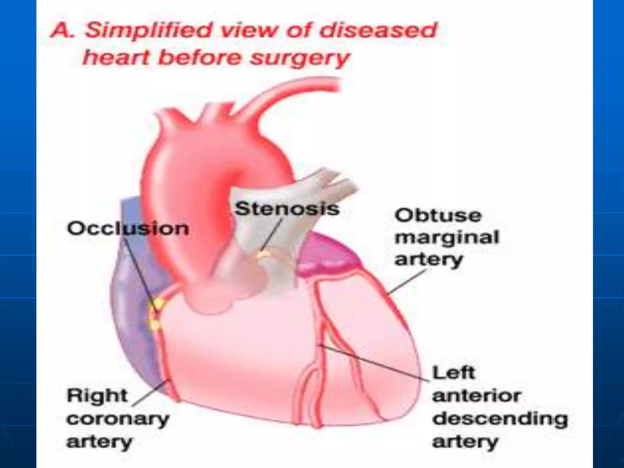 care of CABG patient.ppt
