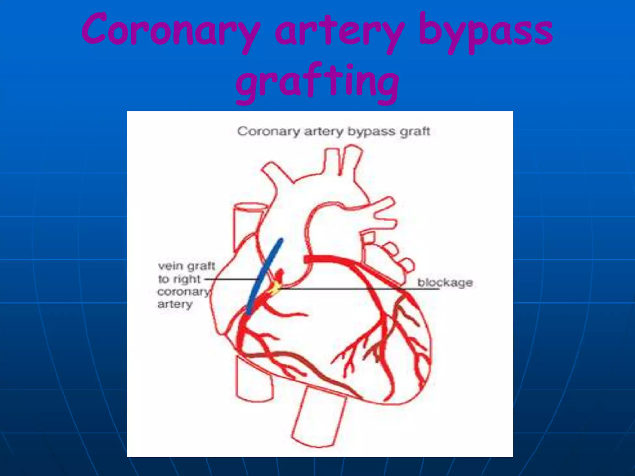 care of CABG patient.ppt