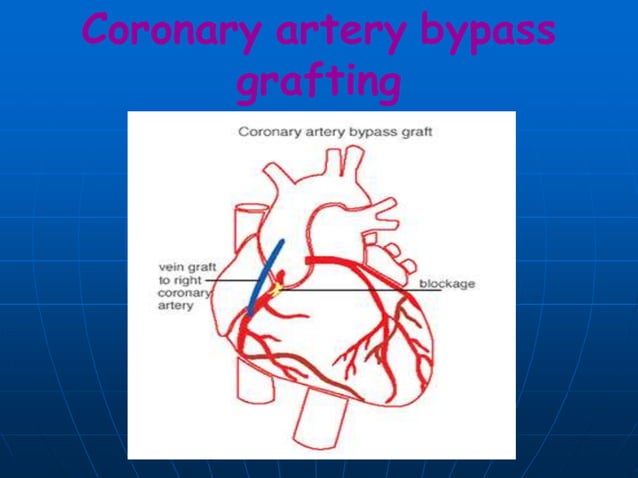 care of CABG patient.ppt