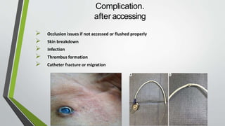 care of chemoport.pptx