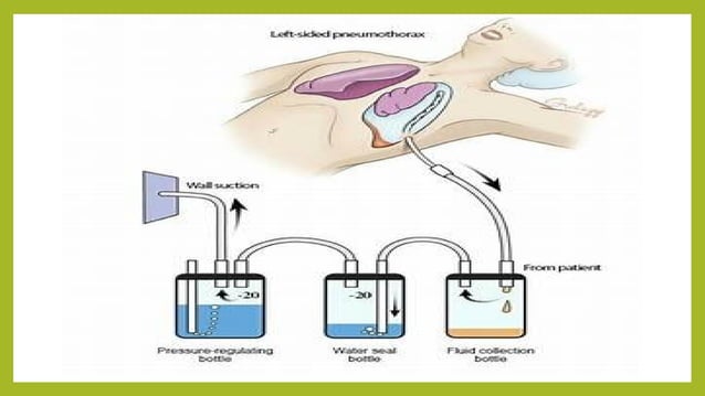 Care of chest drainage. (chapter 8th)-nursing foundation | PPTX