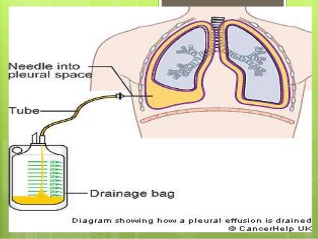 Care of client with chest tube