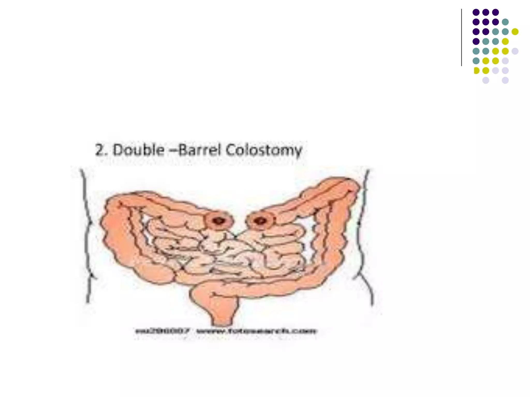 CARE OF PATIENTS WITH OSTOMIES ppt.pptx