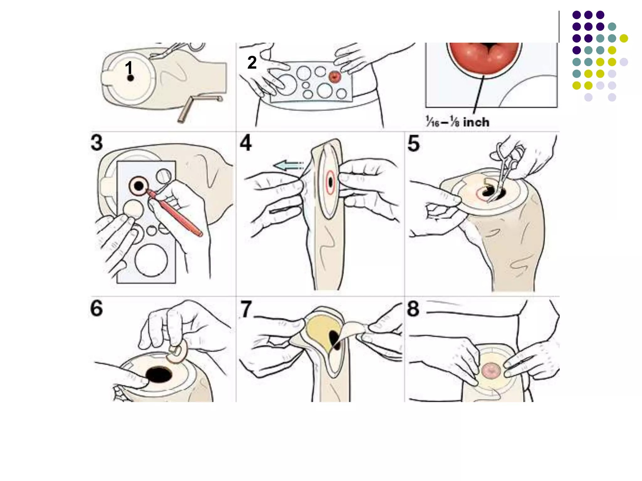CARE OF PATIENTS WITH OSTOMIES ppt.pptx