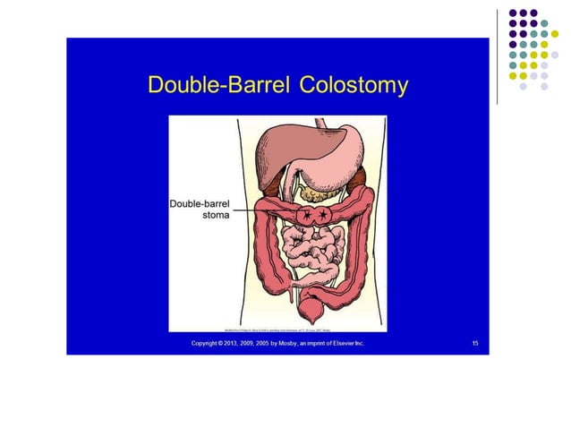 CARE OF PATIENTS WITH OSTOMIES ppt.pptx | Digestive Disorders ...