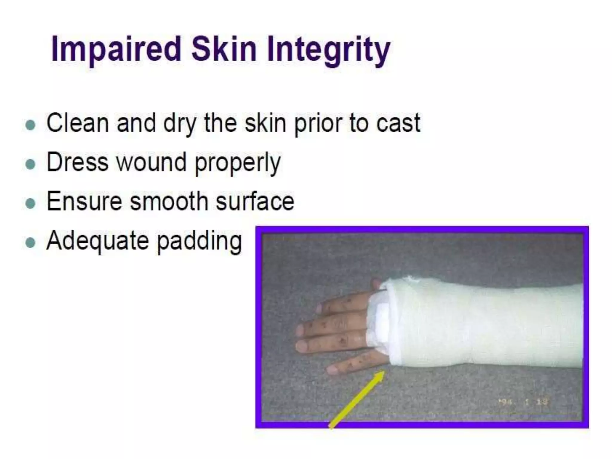 care of patient with cast.pptx