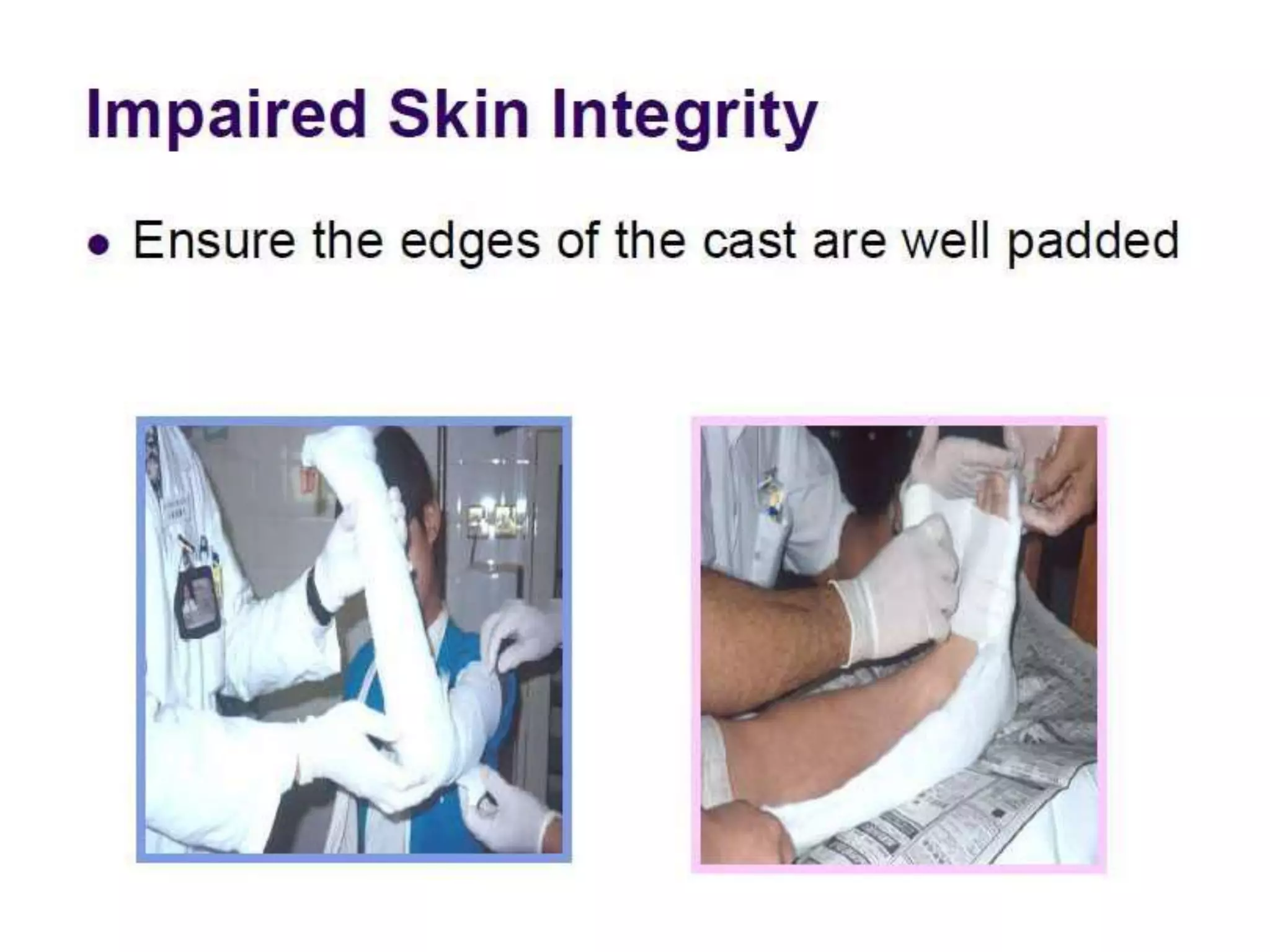 care of patient with cast.pptx