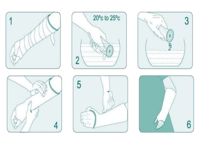 care of patient with cast.pptx