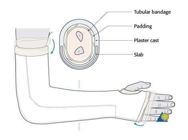 care of patient with cast.pptx