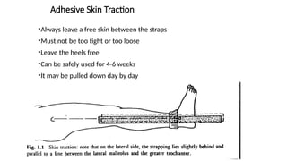 Care of patient with Traction.pptx for B | PPTX