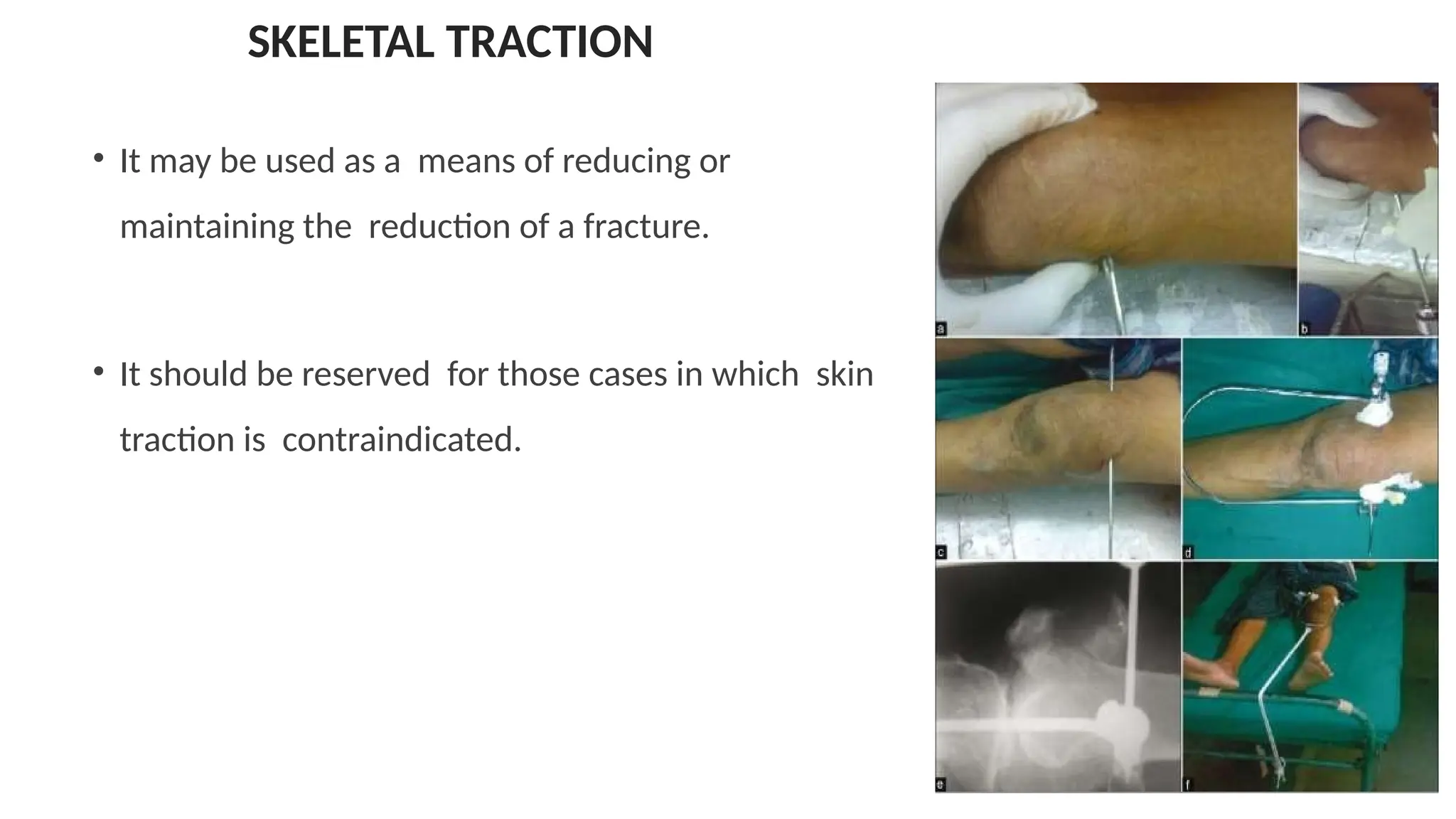 Care of patient with Traction.pptxforbsn | PPTX