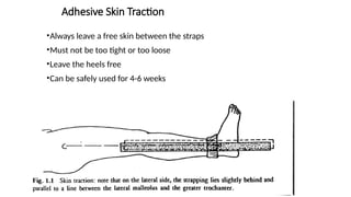 Care of patient with Traction.pptxforbsn | PPTX