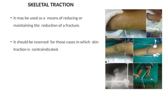 Care of patient with Traction.pptxforbsn | PPTX
