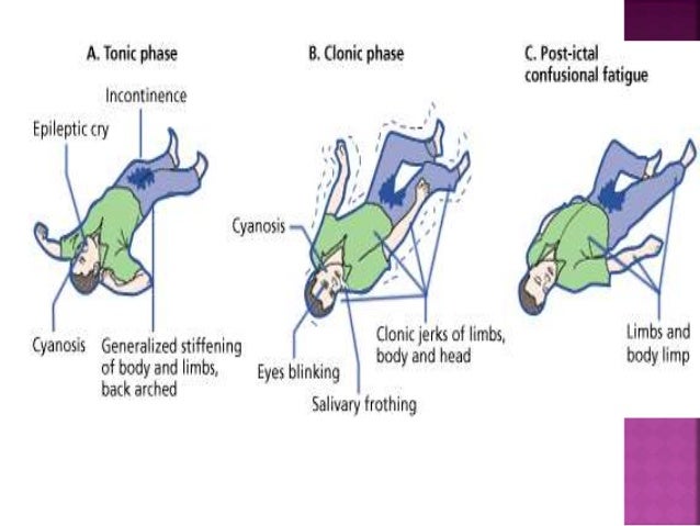 Care of the patient with convulsion
