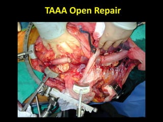 Care of the Post Operative Vascular Patient.ppt