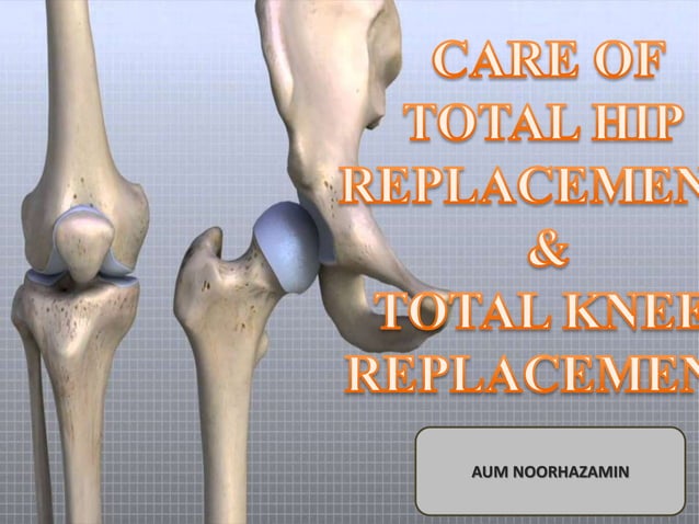 Care of THR & TKR | PPTX