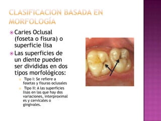 Caries | PPTX