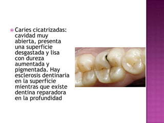 Caries | PPTX
