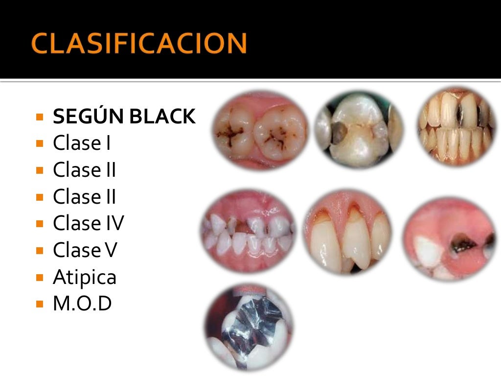 Caries
