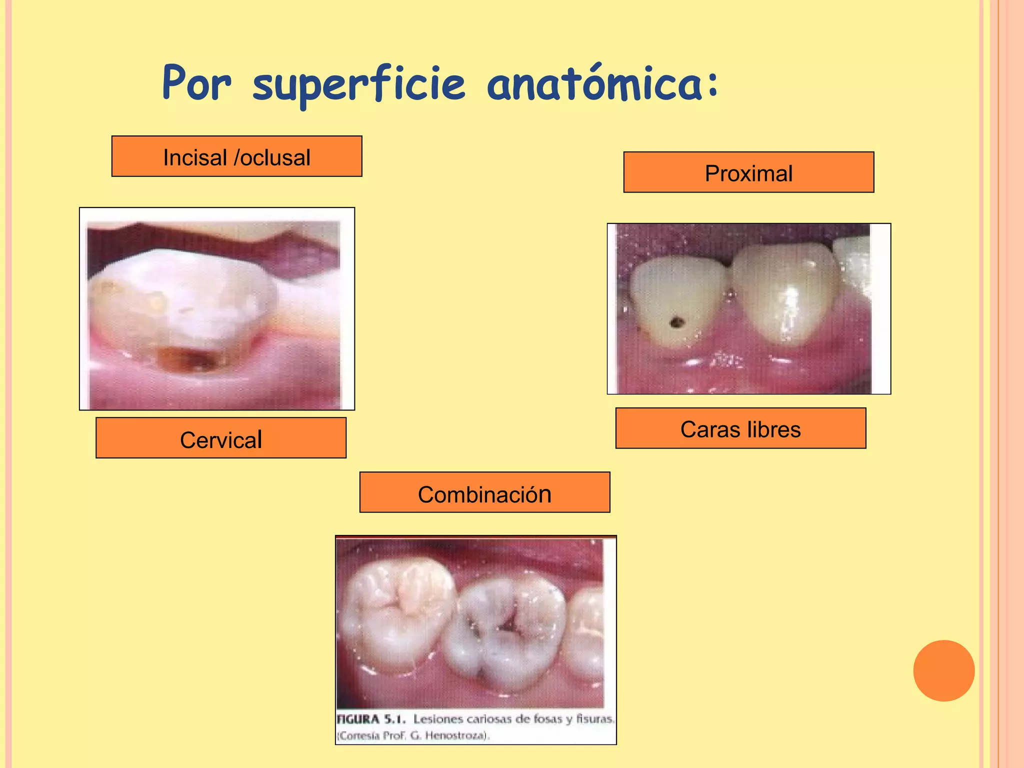 Caries | PPT | Dental Health | Diseases and Conditions