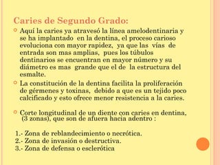 Caries | PPT