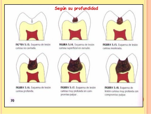Caries