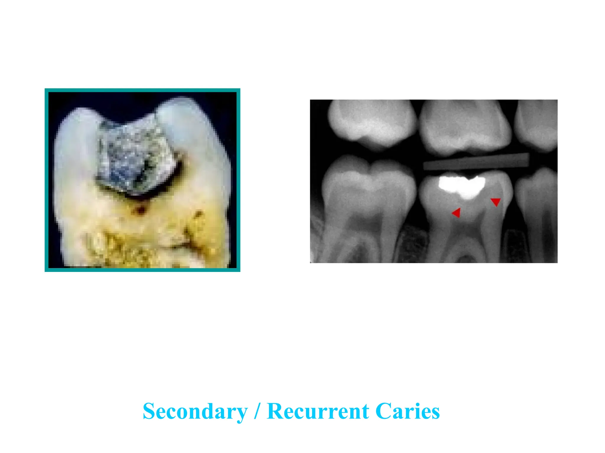 Dental Caries for dentistry students .ppt