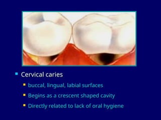 Dental Caries for dentistry students .ppt