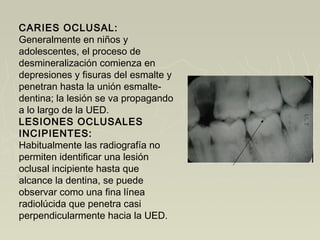 Caries clase | PPT
