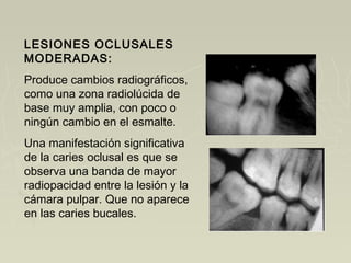 Caries clase | PPT