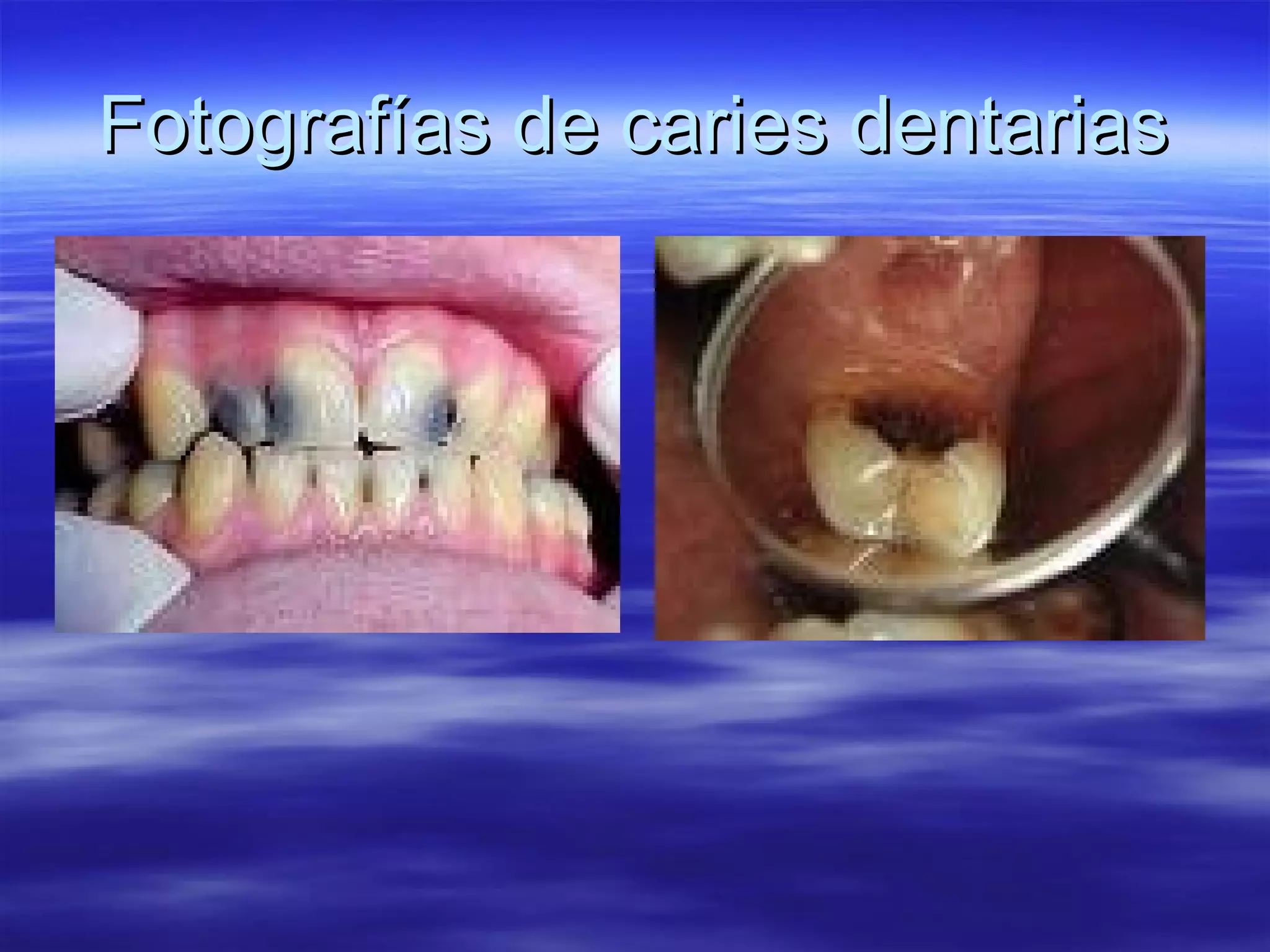 Caries Dentarias | PPT