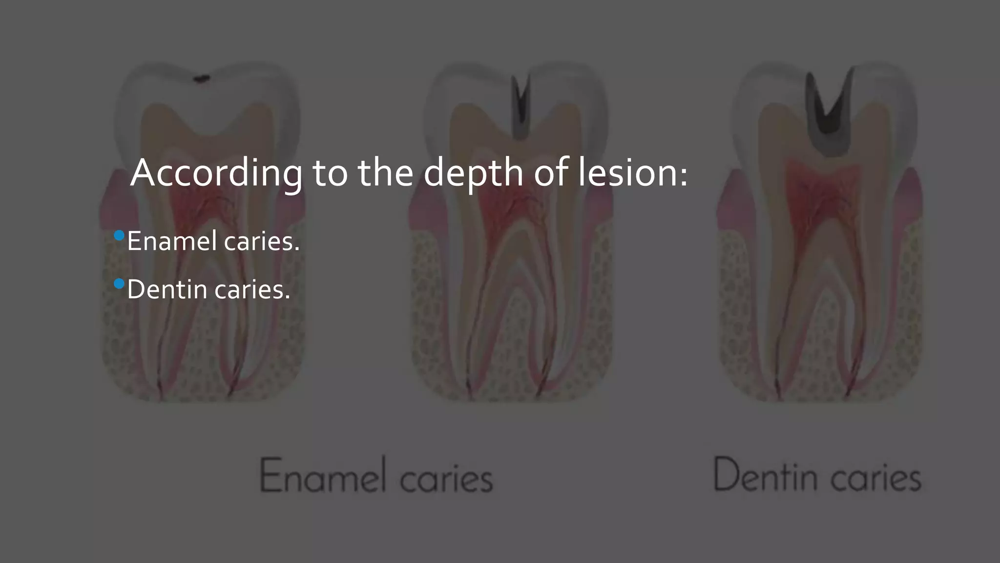 Caries Classification.pptx