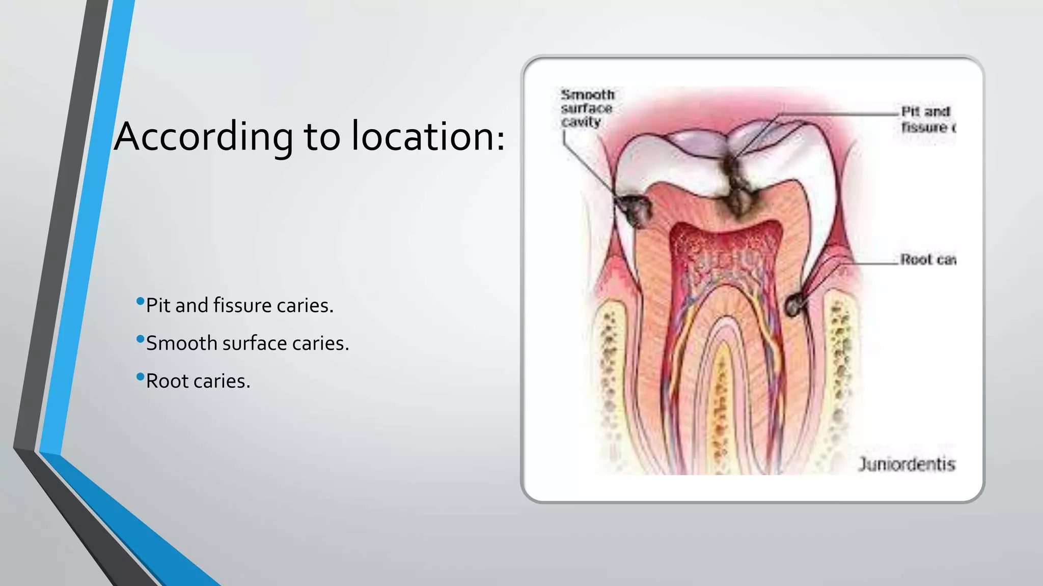 Caries Classification.pptx