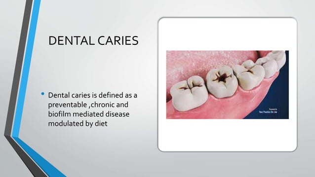 Caries Classification.pptx