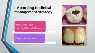 Caries Classification.pptx