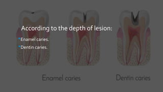 Caries Classification.pptx