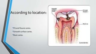 Caries Classification.pptx